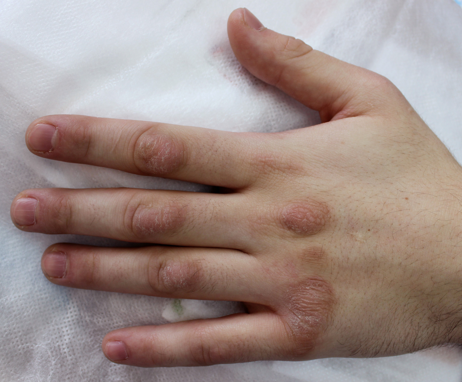 Scleroderma: all you need to know about this autoimmune disease