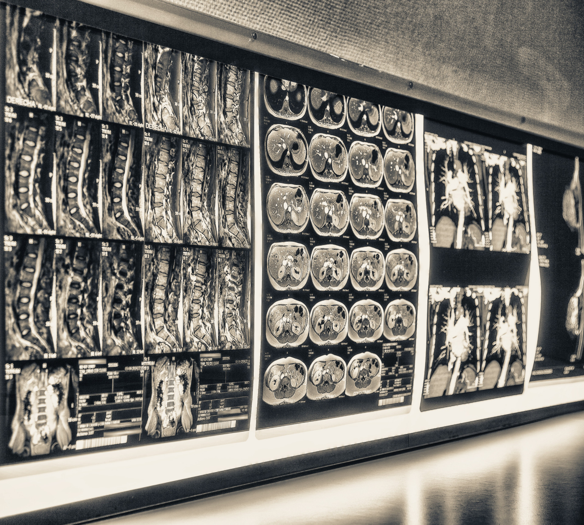 Scleroderma: all you need to know about this autoimmune disease