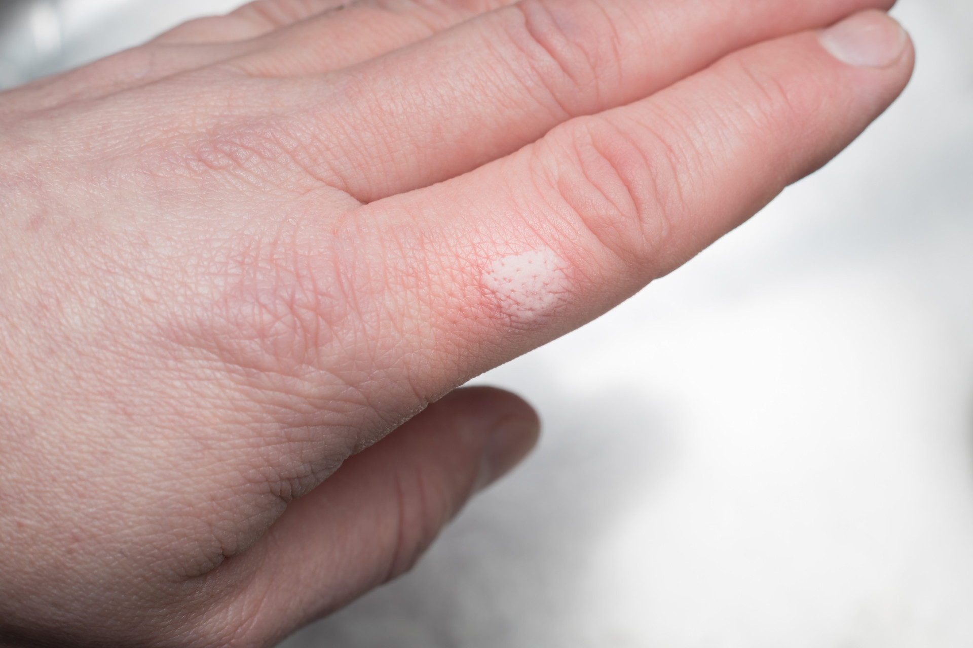 Scleroderma: all you need to know about this autoimmune disease