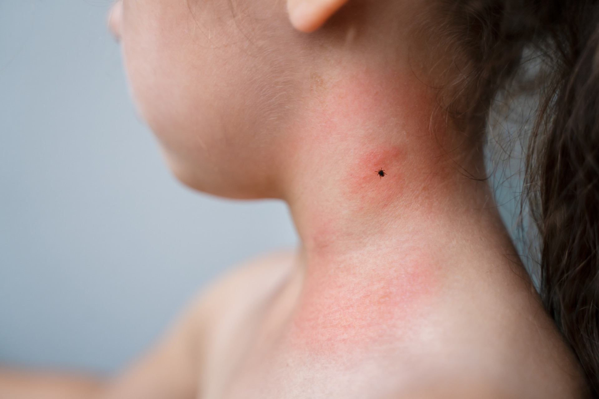 Understanding tick-related illnesses: Essential information and ...