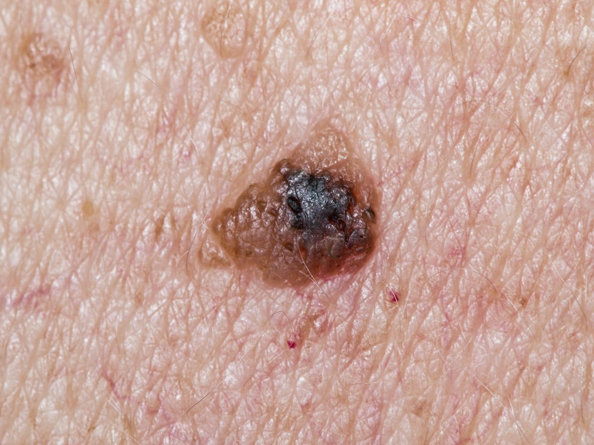 Skin Cancer Symptoms You Should Never Ignore