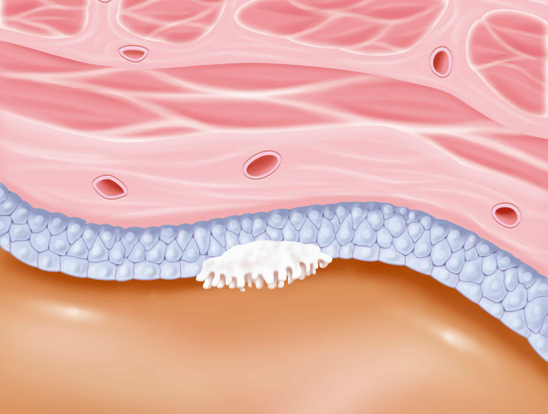 Bladder cancer: the signs, symptoms, and treatments