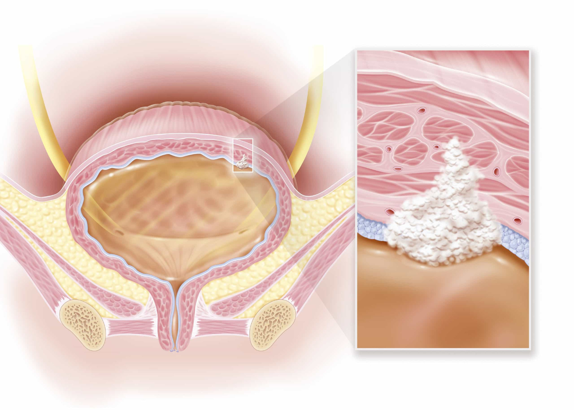 Bladder cancer: the signs, symptoms, and treatments