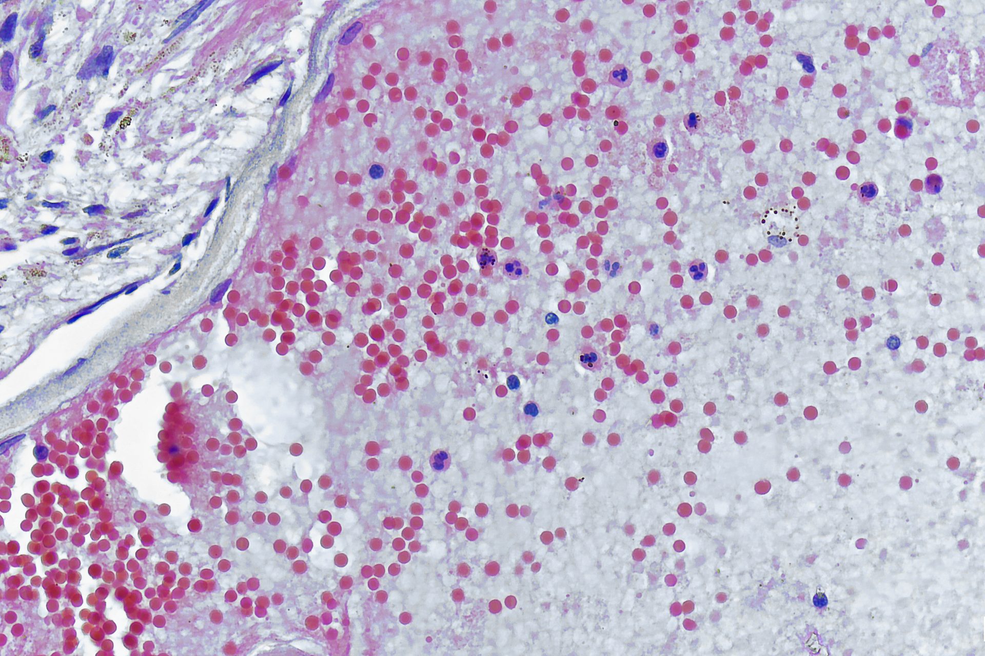 An ancient zombie virus from Siberian permafrost has been resurrected