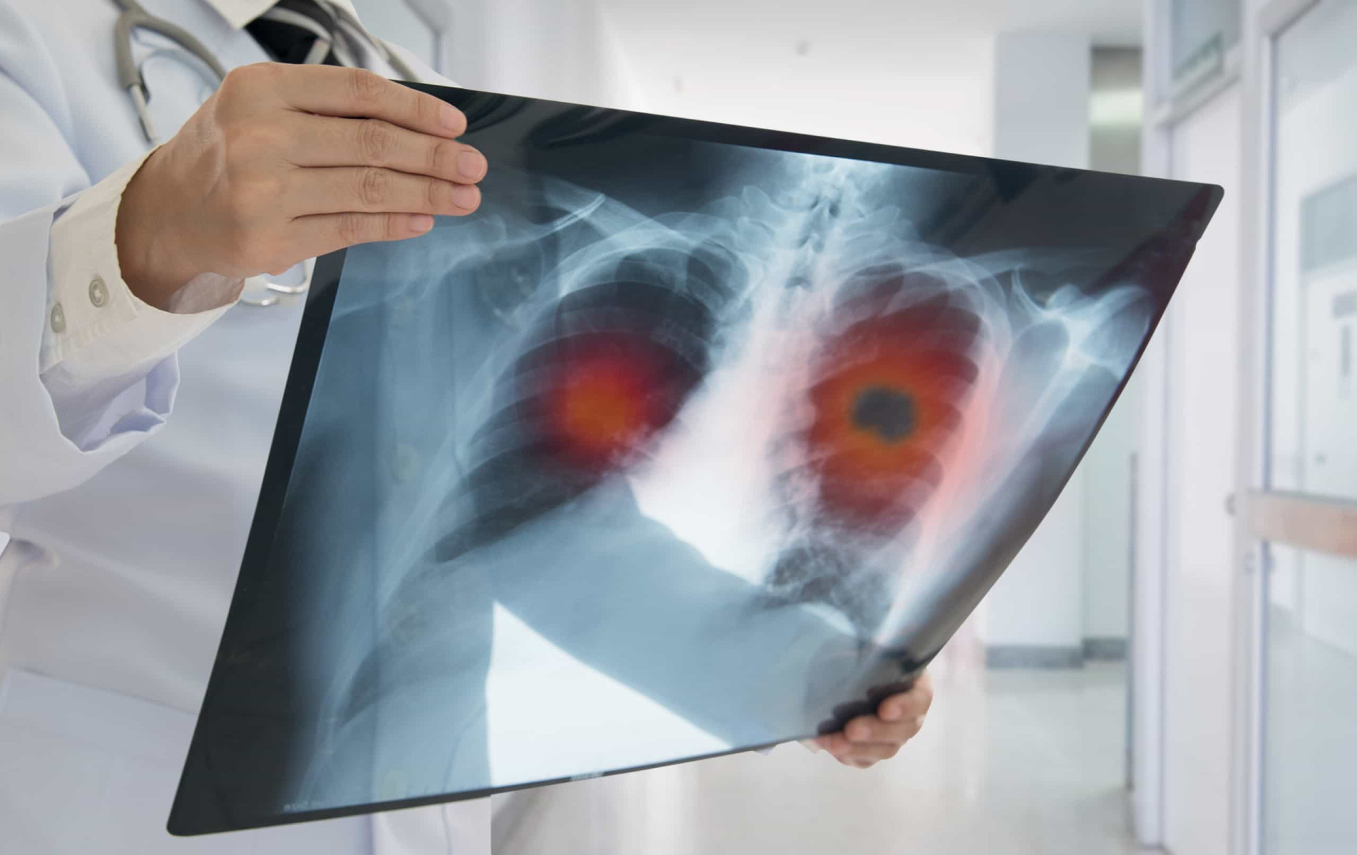 Lung cancer could be detected more than 5 years before diagnosis, says ...