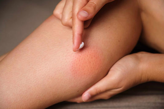 The reason why some insect bites swell up The reason why some insect bites swell up