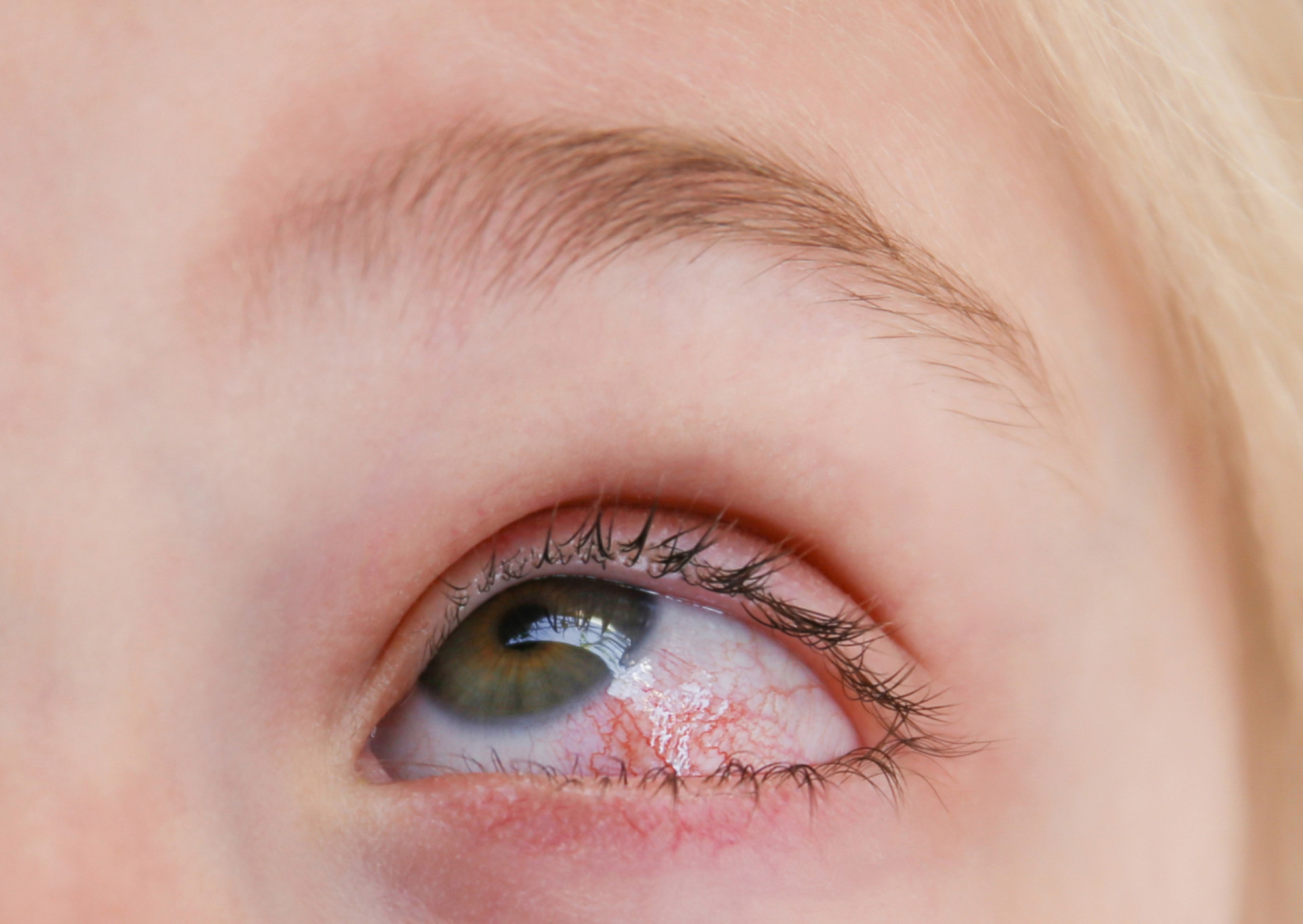 Bizarre tropical diseases you've probably never heard of