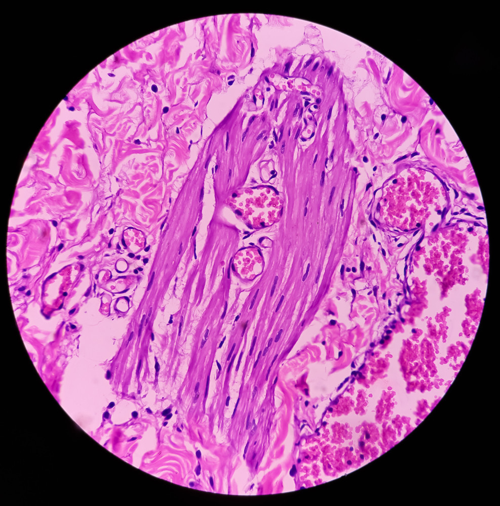 The rare inflammatory condition that is sarcoidosis