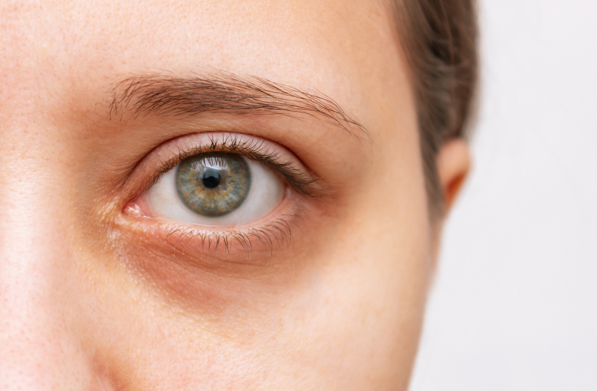 Ways to improve the look of your under-eyes