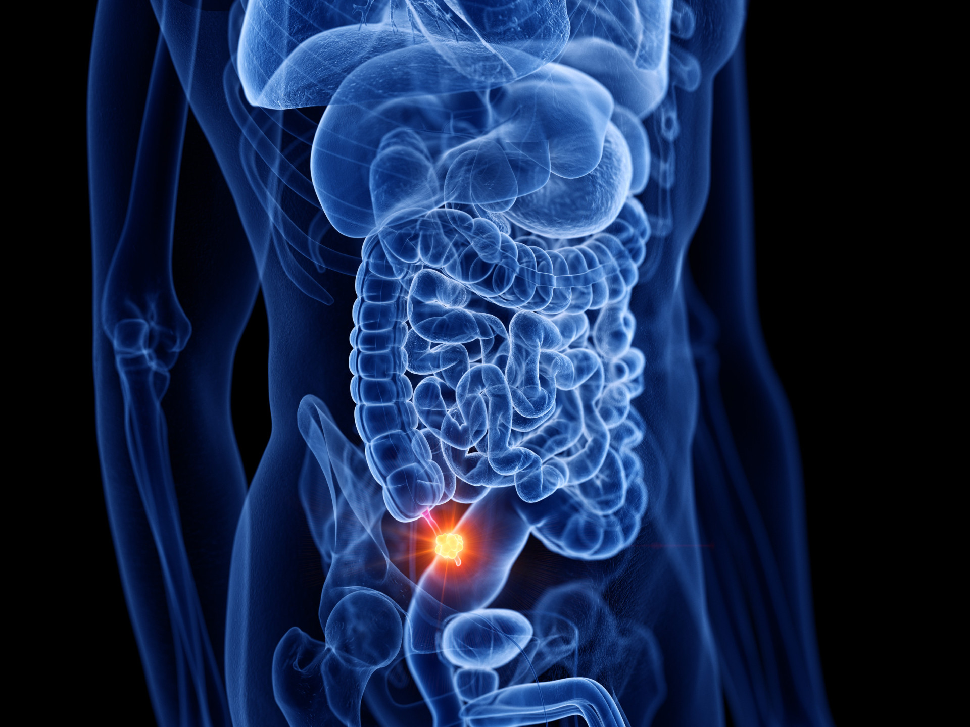 Todo lo que debes saber sobre la apendicitis