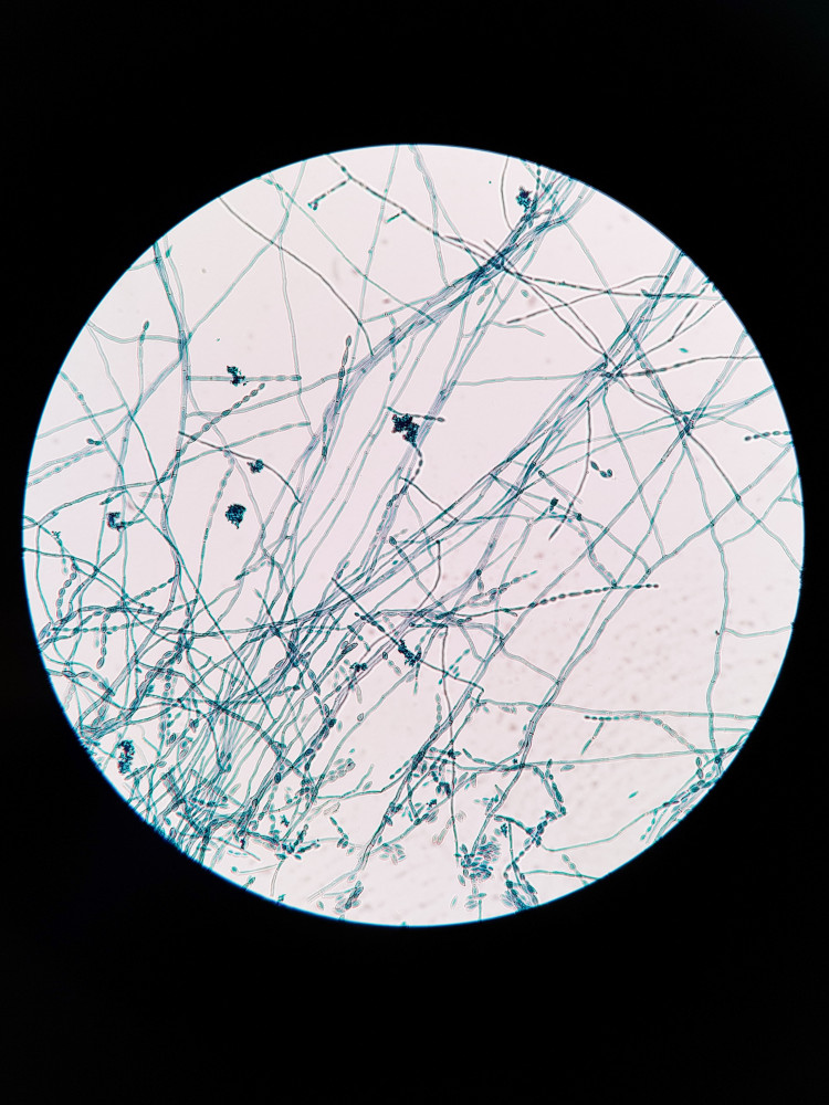 Mycoses: ce que vous ignorez au sujet de ces infections fongiques