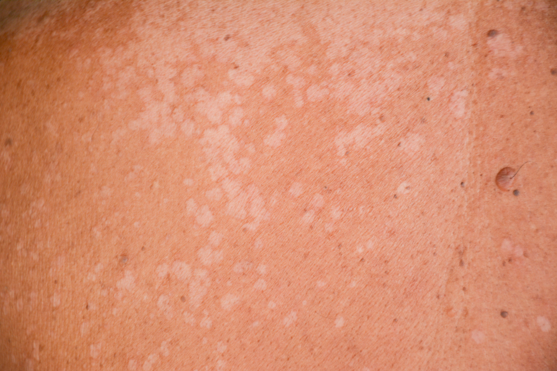 Infections fongiques: ce que vous ignorez au sujet des mycoses