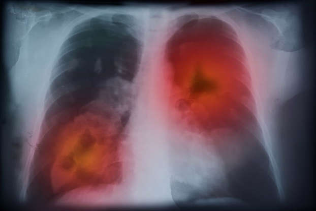 Everything you need to know about lung cancer Everything you need to know about lung cancer