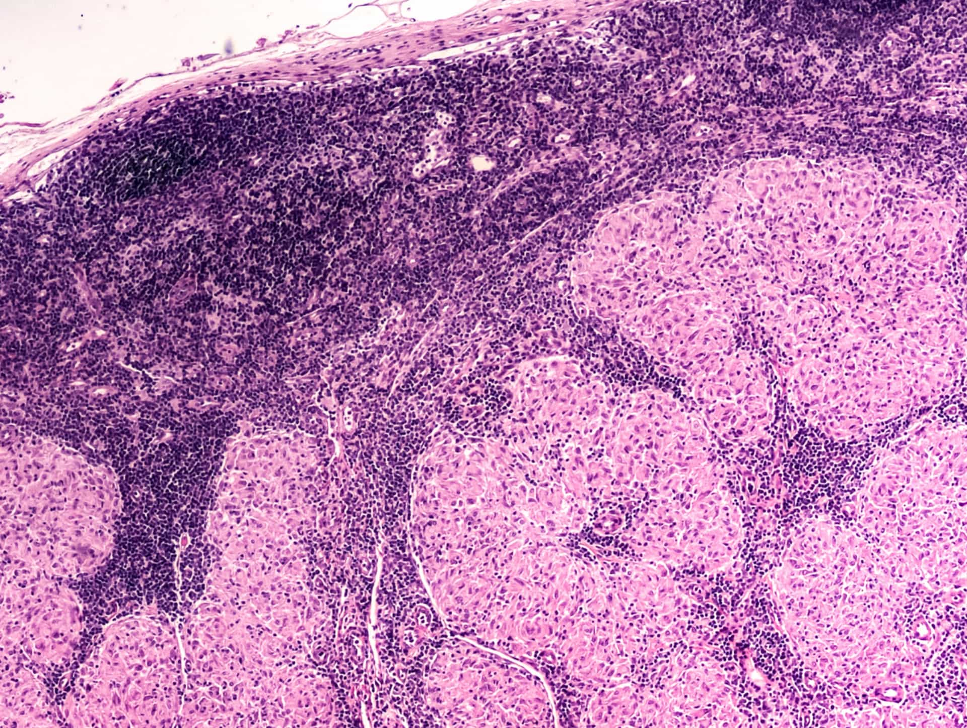 How serious is the inflammatory condition known as sarcoidosis?