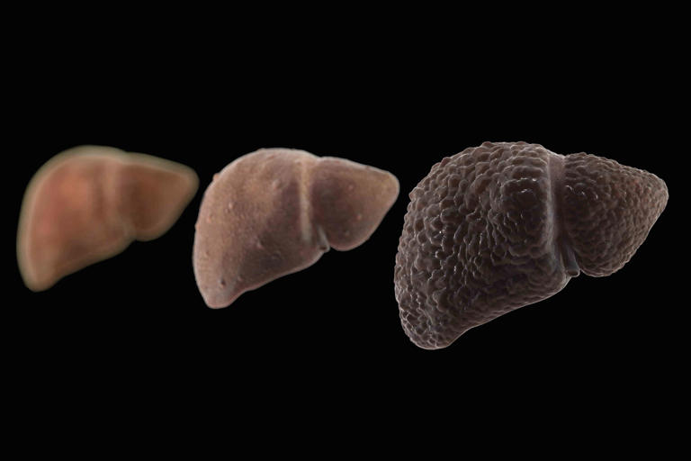 Understanding Liver Enzymes and Signs of Liver Dysfunction