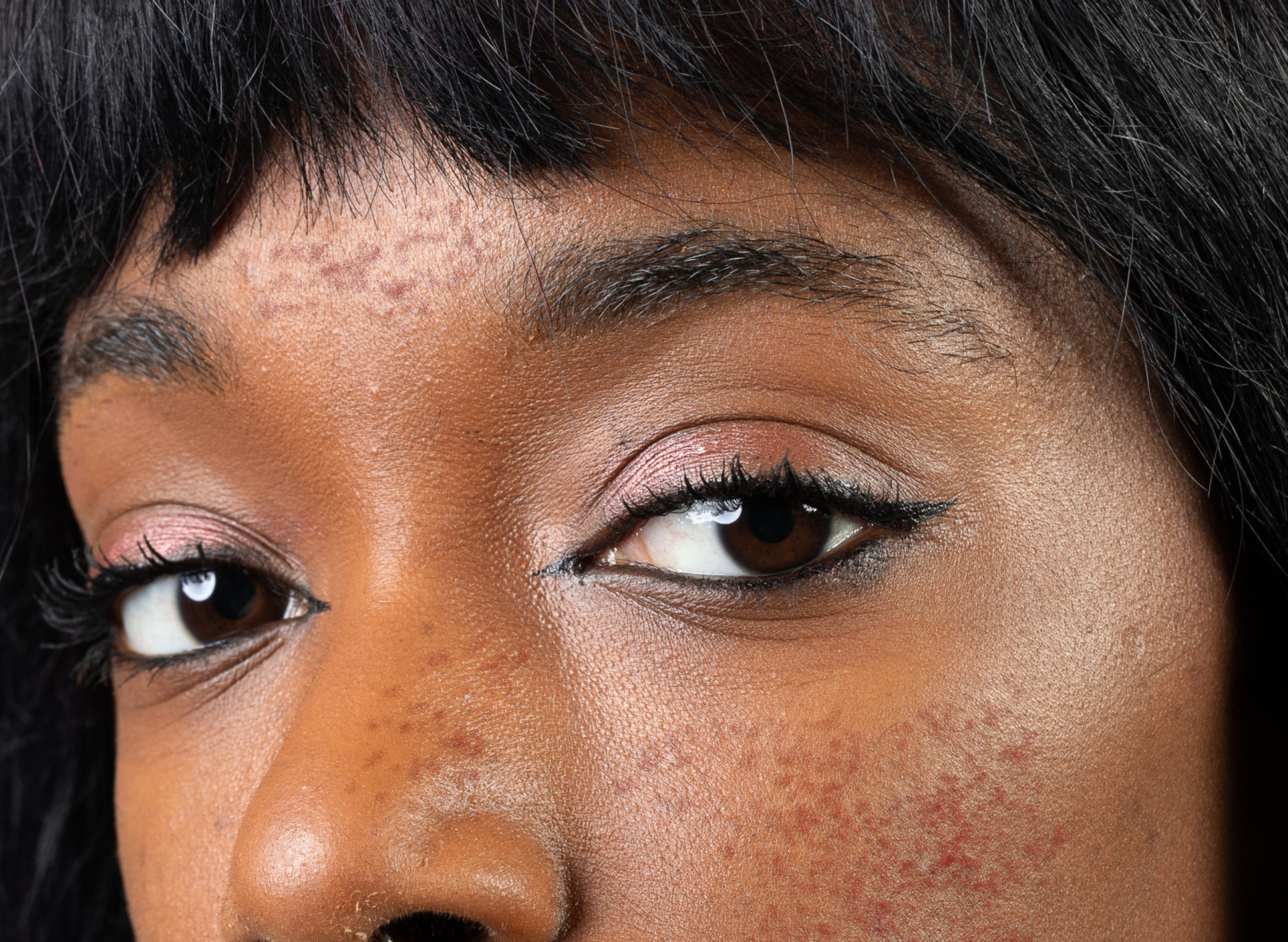 Comment faire face à la maladie de la peau appelée rosacée