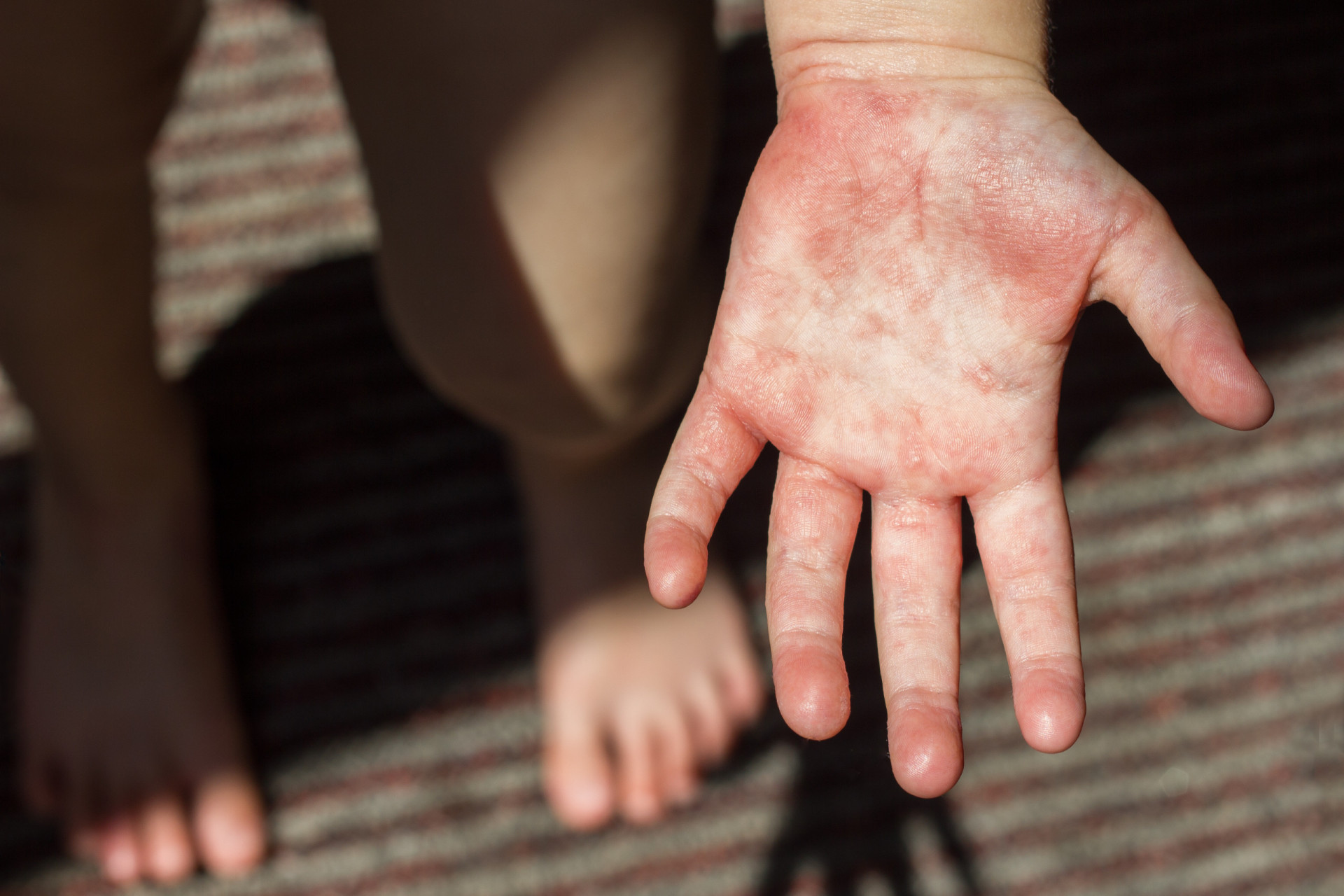 How serious is scarlet fever?
