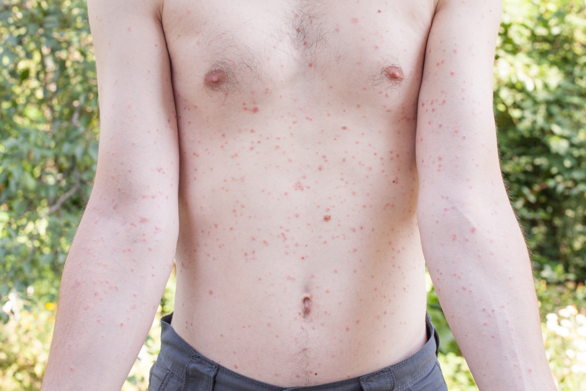 How serious is scarlet fever?
