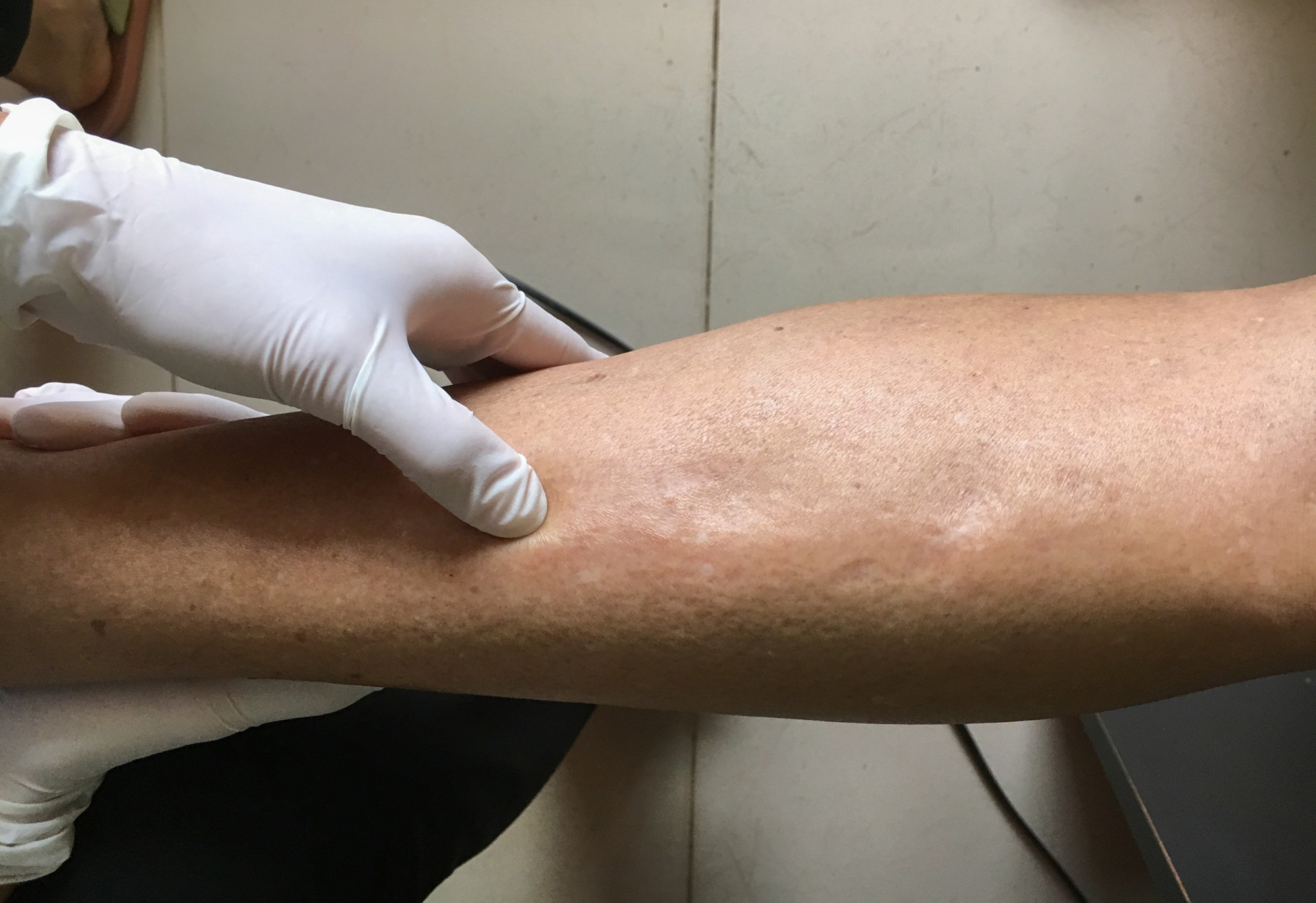 Everything you need to know about edema