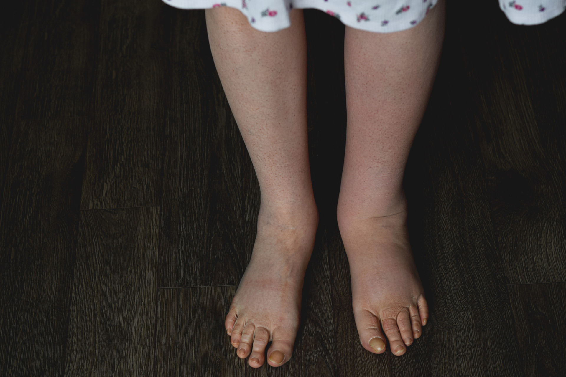 Everything you need to know about edema