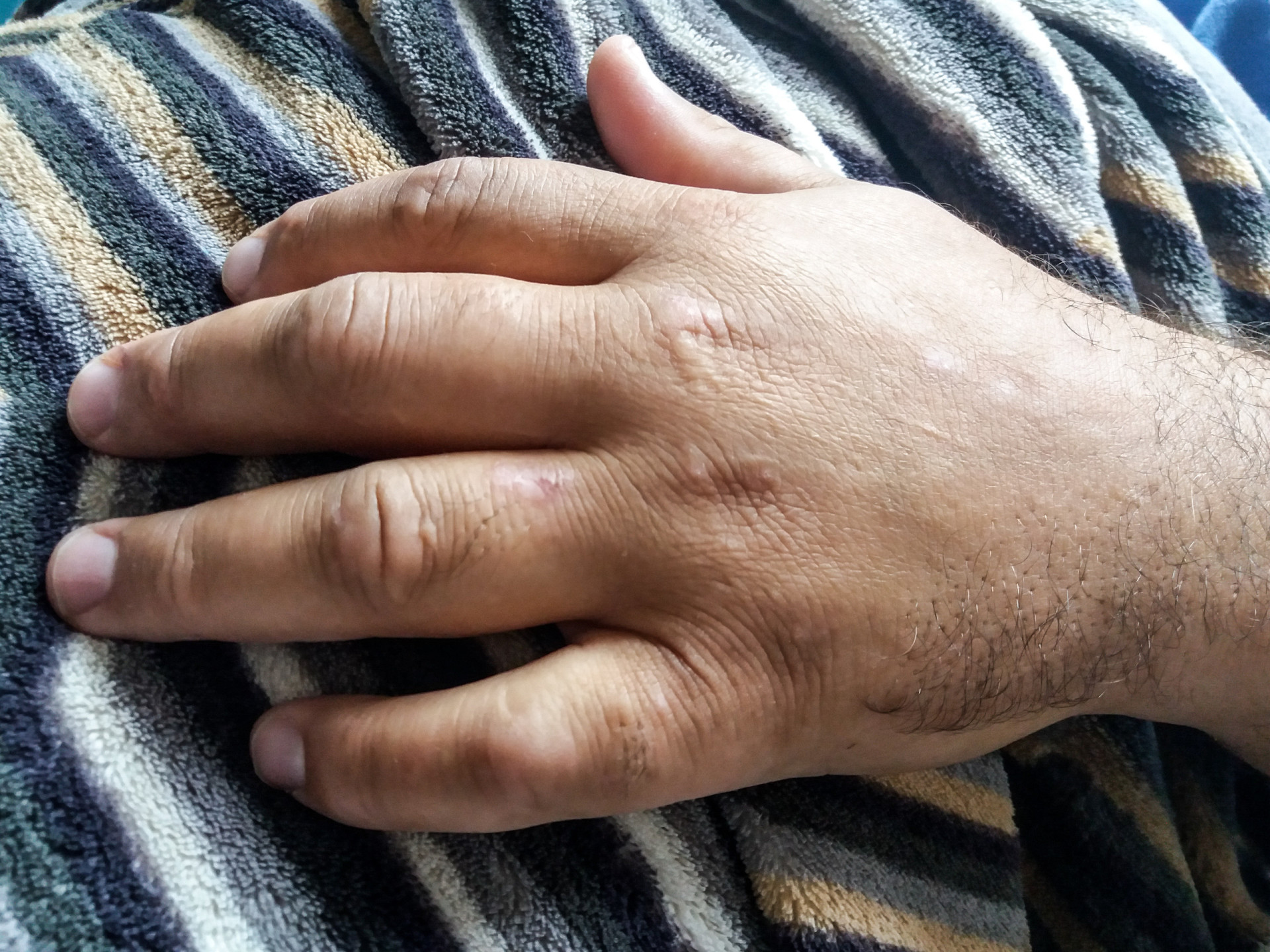 Everything you need to know about edema