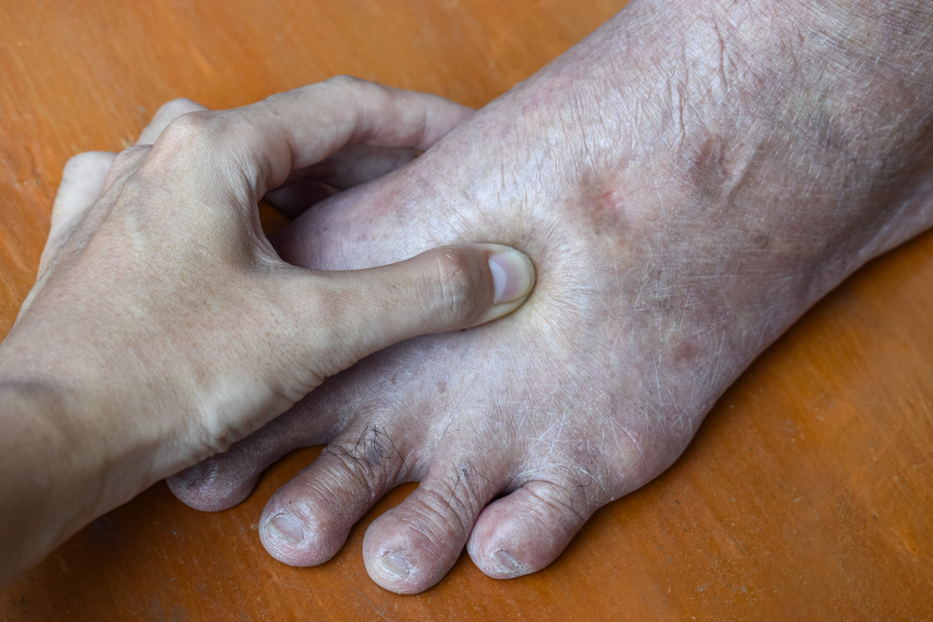 Everything you need to know about edema