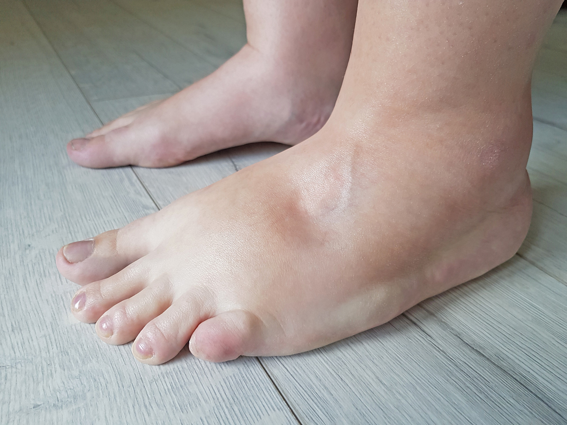 Everything you need to know about edema