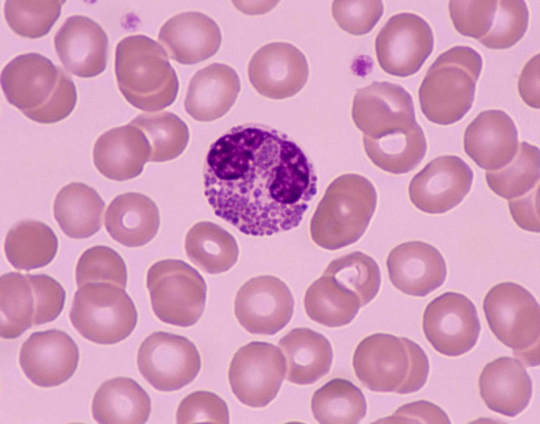 High eosinophils and the risk of cancer