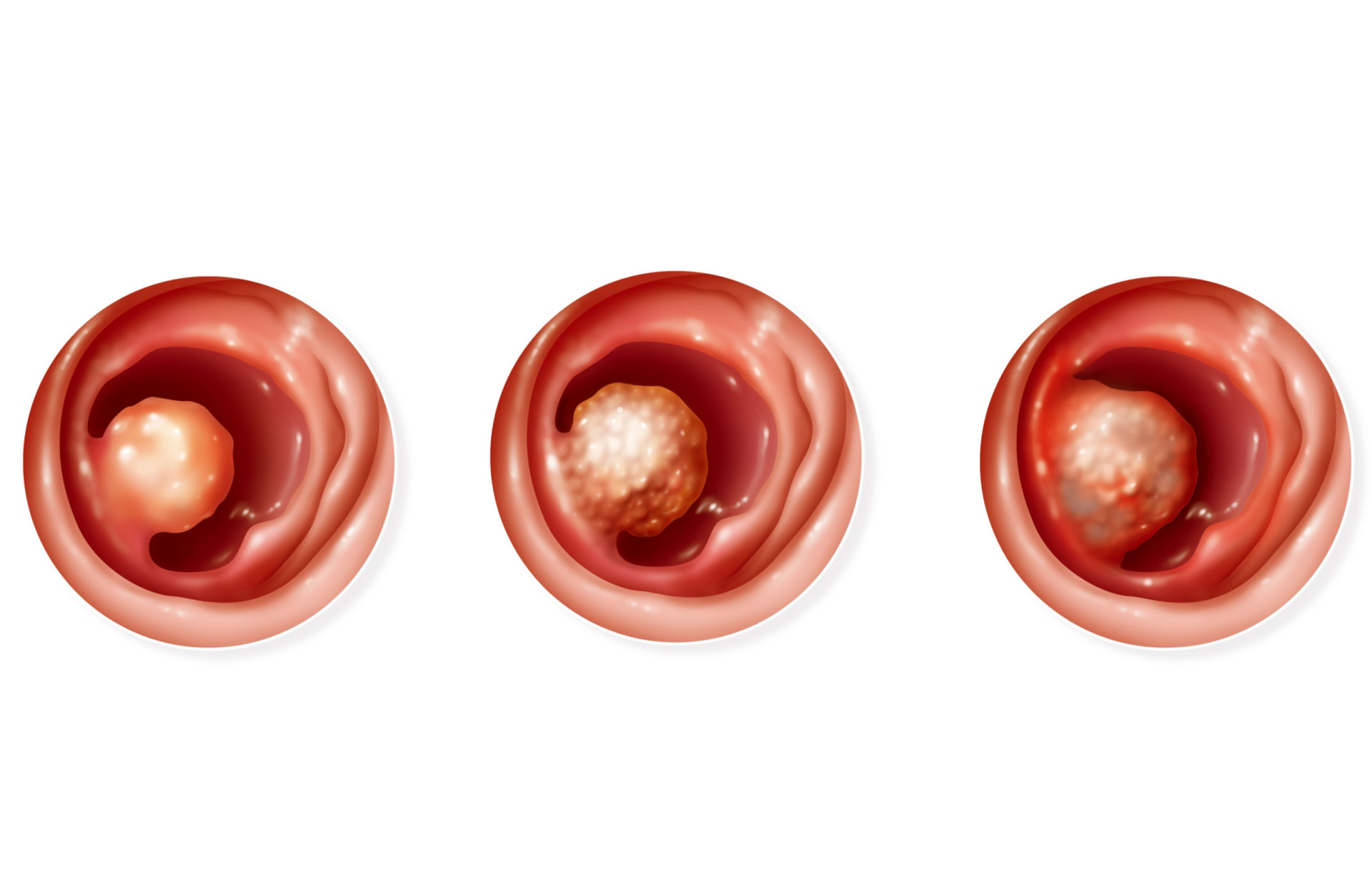 What exactly is colorectal cancer?