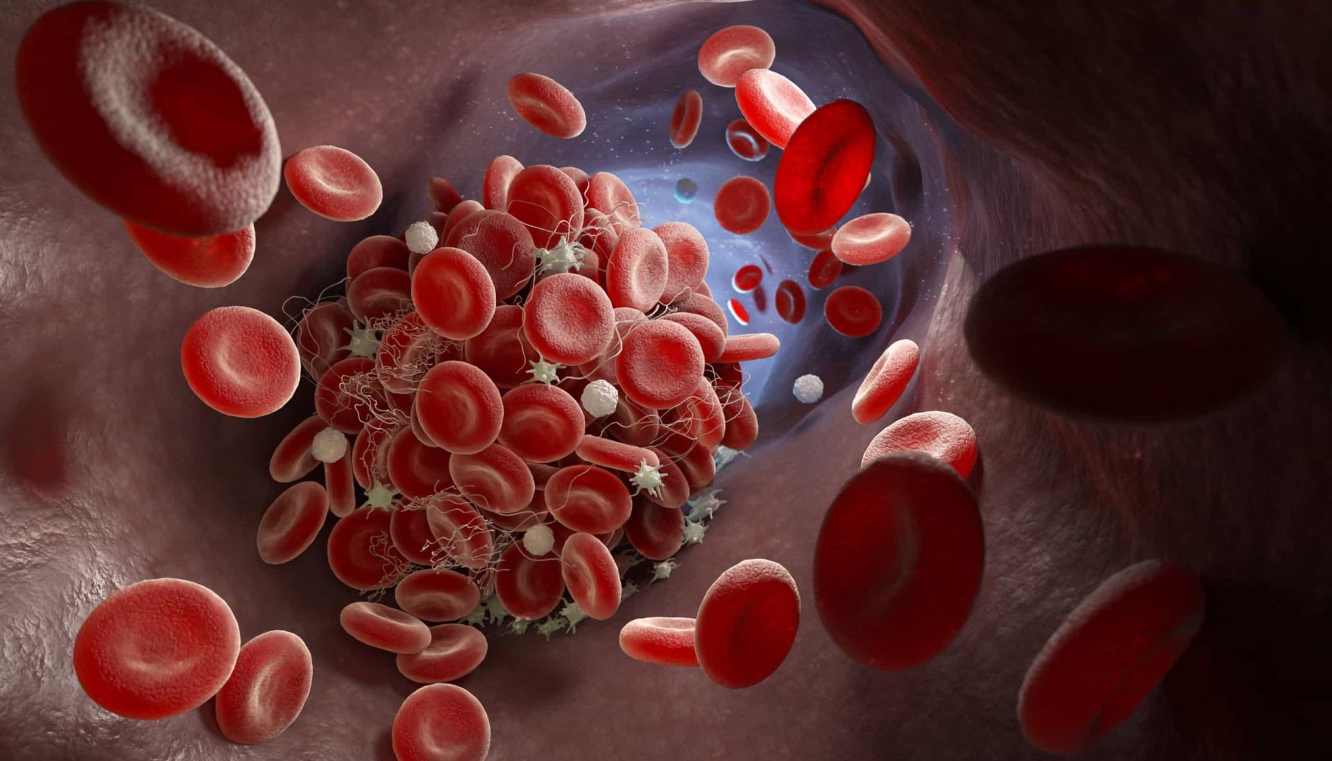 Understanding ITP: A rare autoimmune disorder