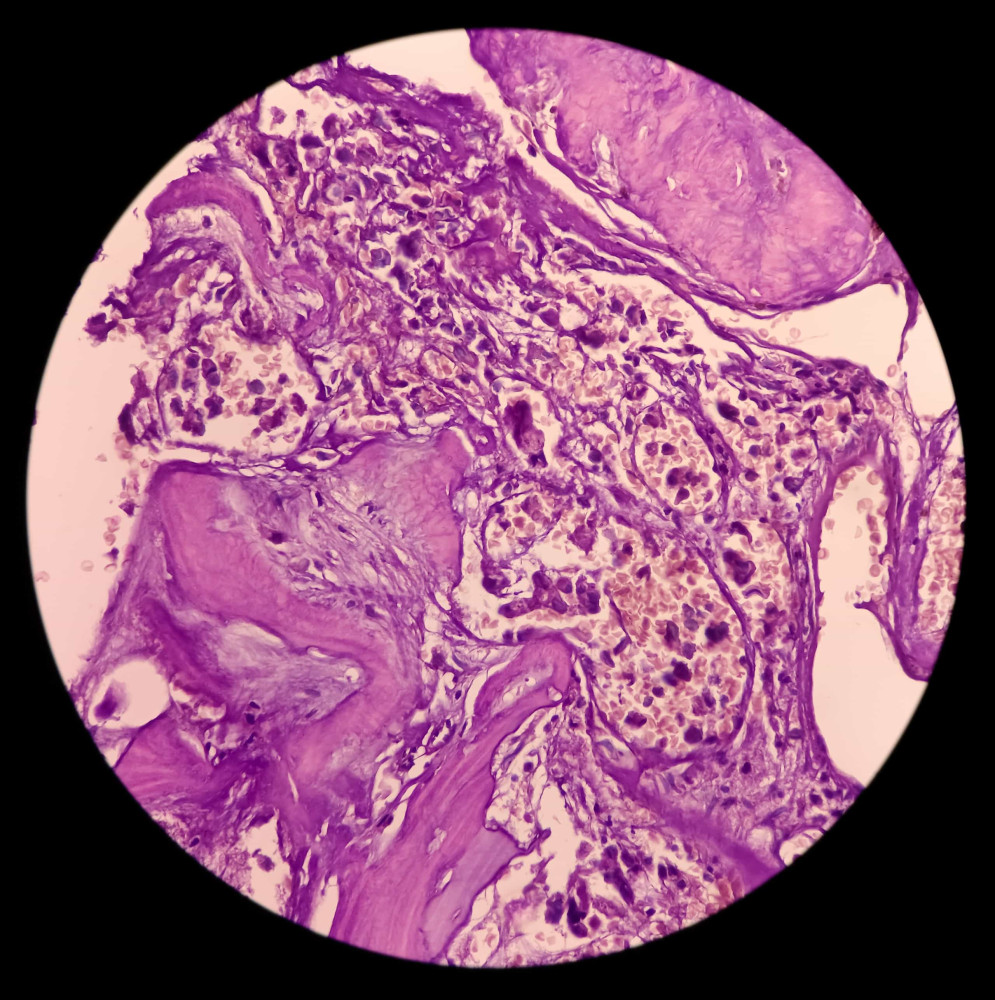 Rzadkie nowotwory, które stanowią wyzwanie dla lekarzy