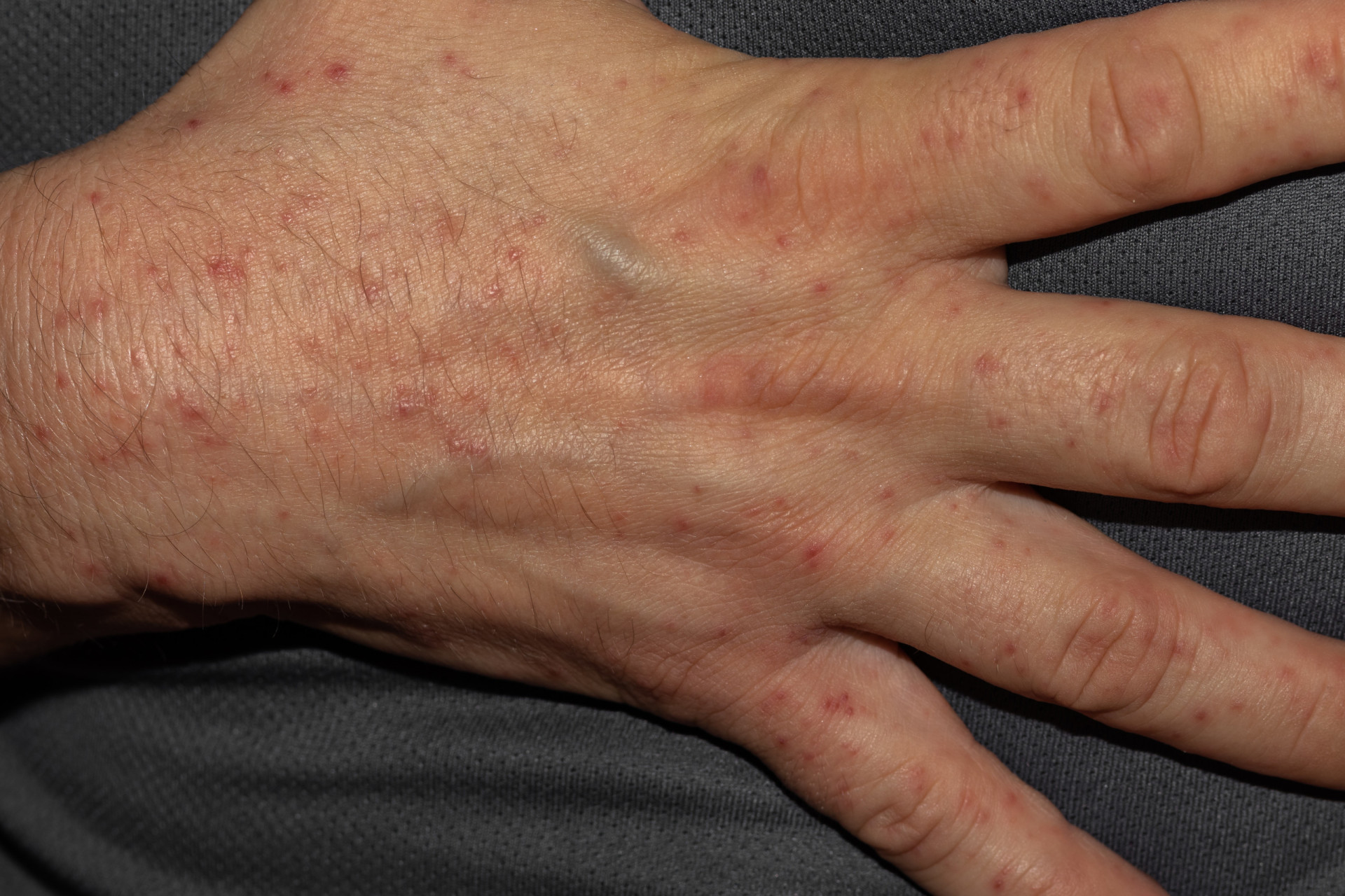 Scarlatine: comment diagnostiquer et traiter cette maladie