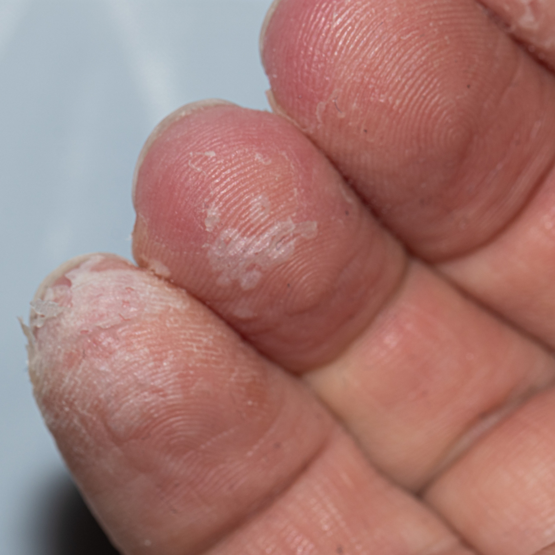 Scarlatine: comment diagnostiquer et traiter cette maladie