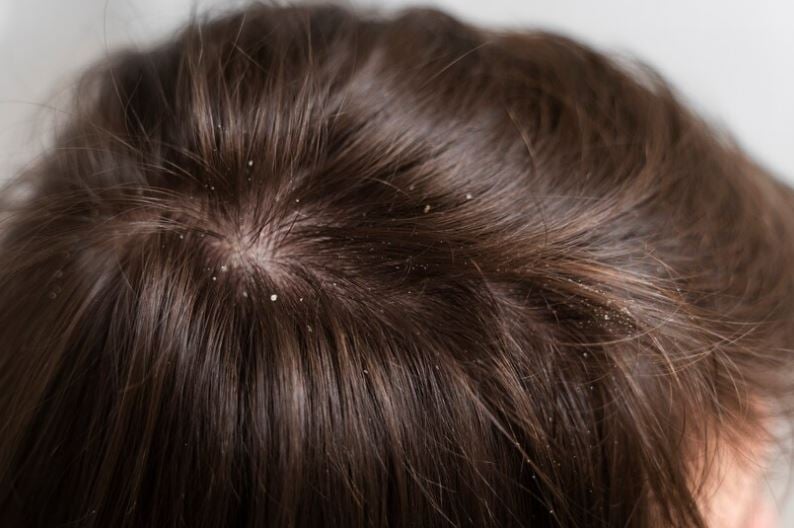 Fim do constrangimento: Dicas para se livrar da caspa