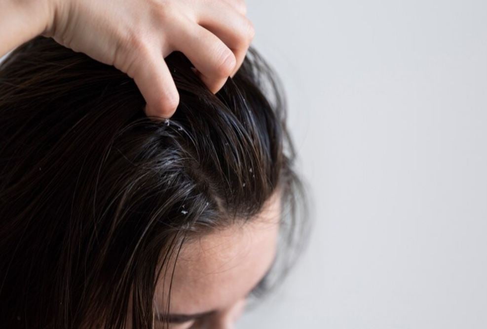 Para não ter constrangimento: como se livrar da caspa