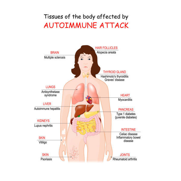 The Link Between Vitamin D and AutoImmune Disease: Study The Link Between Vitamin D and AutoImmune Disease: Study