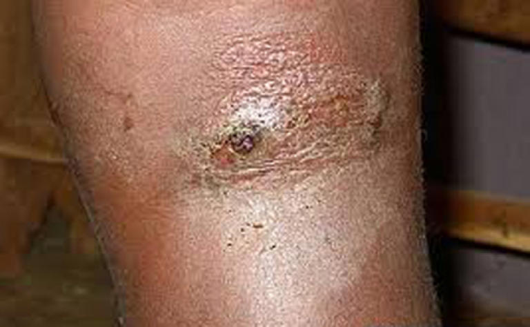 RDC : campagne de prise en charge des patients souffrant des plaies ...