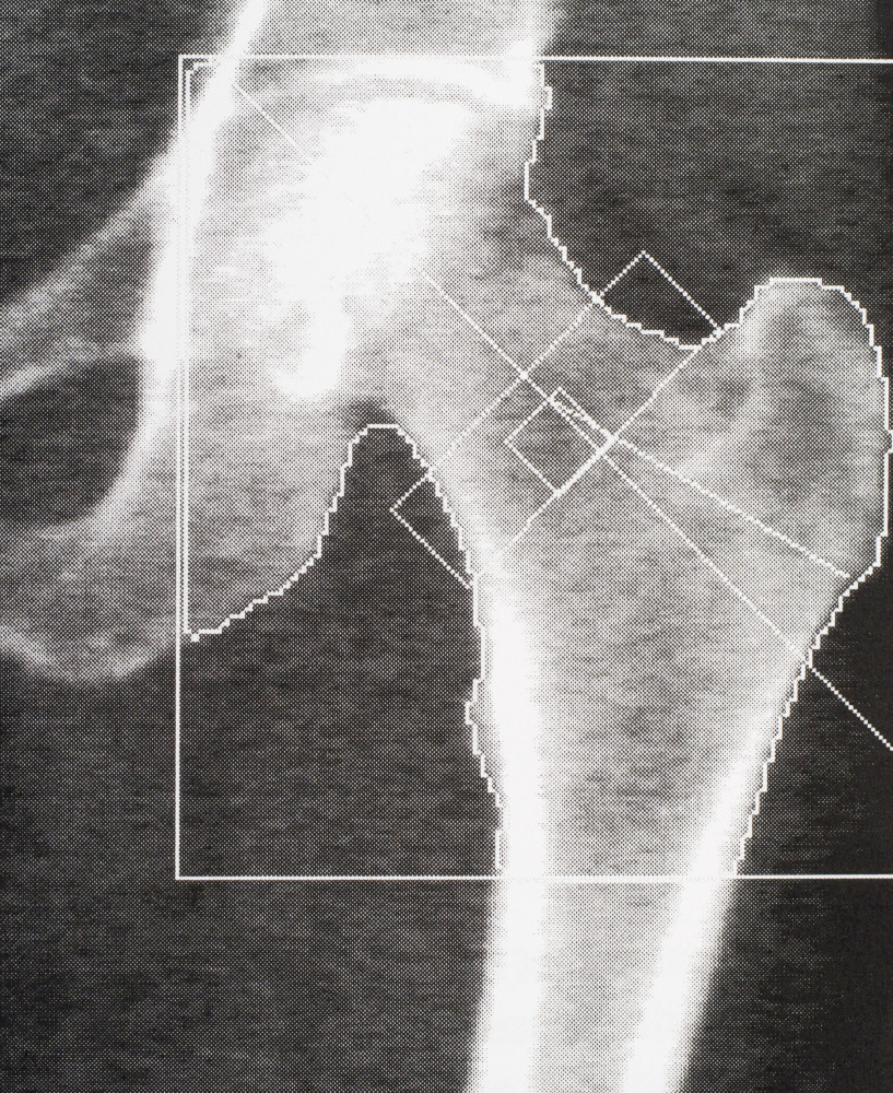 Tout ce que vous devez savoir sur l'ostéoporose