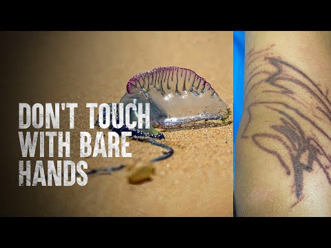 Surviving a Portuguese man o' war encounter
