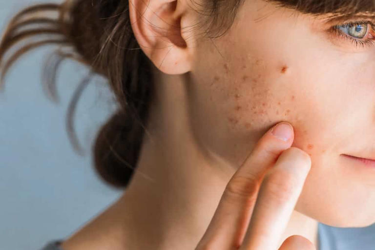 Say Good-Bye to Acne With These Proven Home Remedies