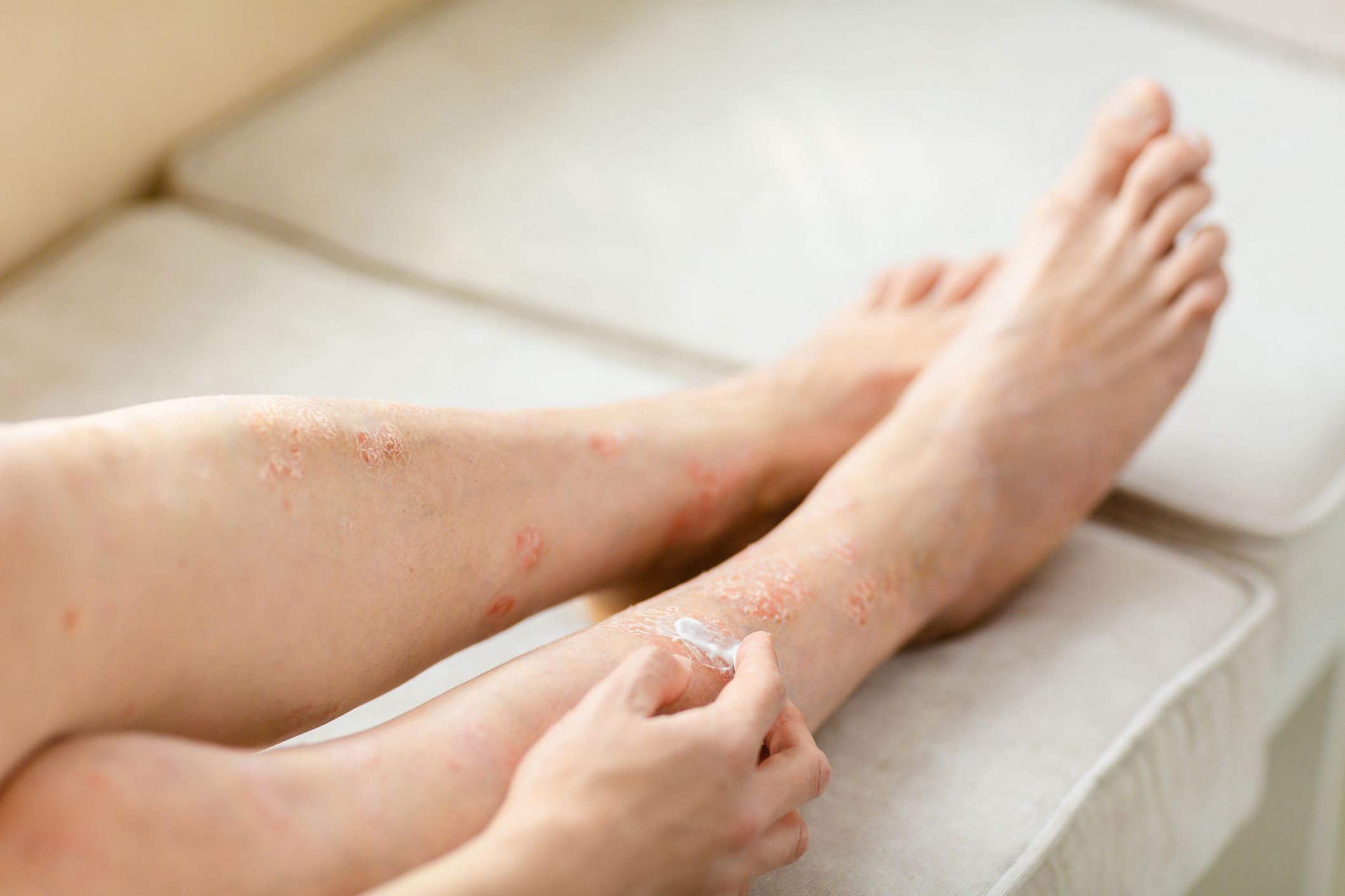 What Are the Most Effective Psoriasis Therapy Options?
