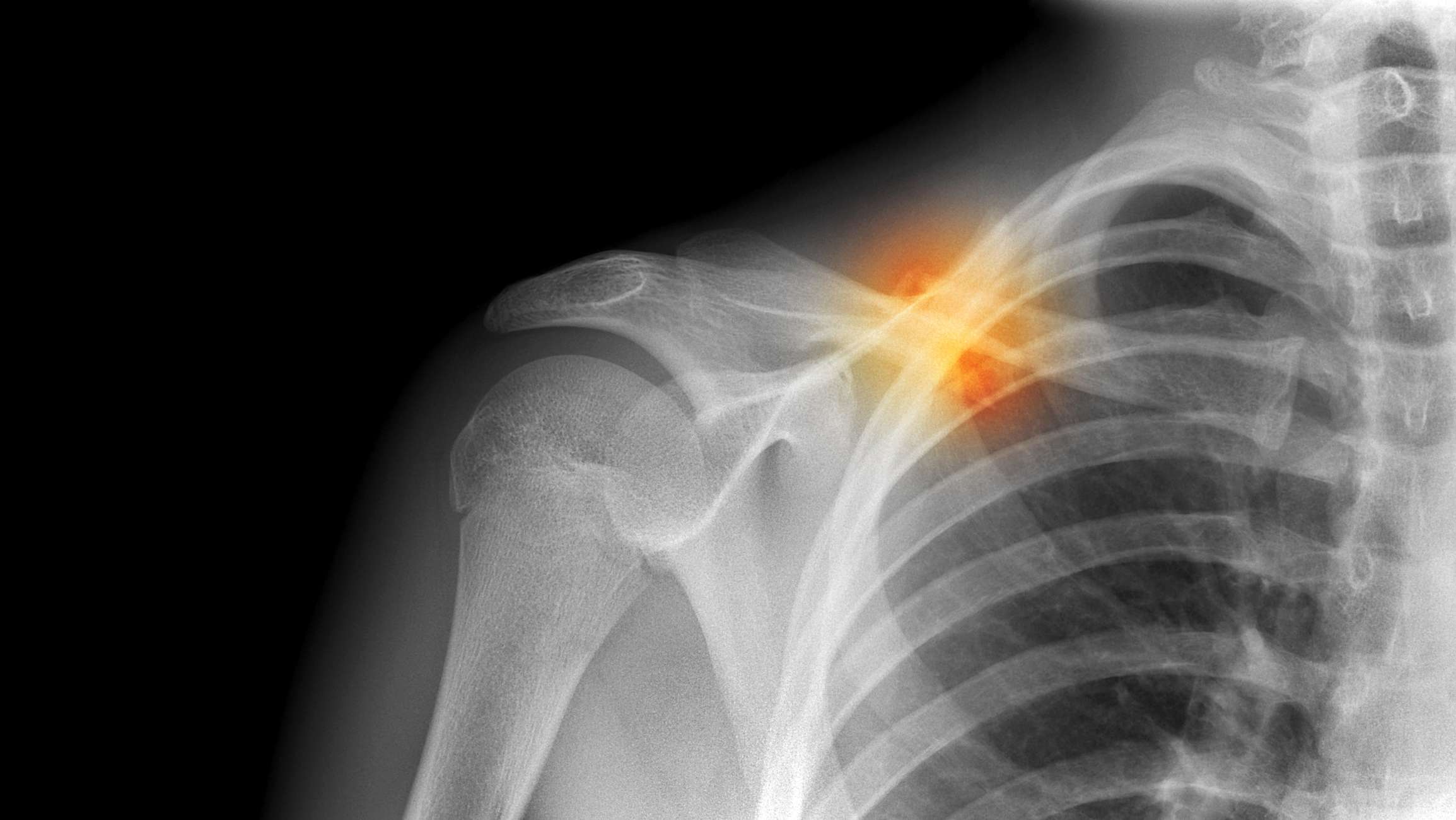 8 causes of collarbone pain