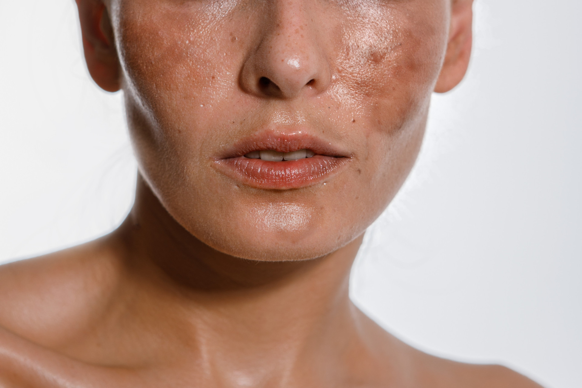 Everything you need to know about melasma