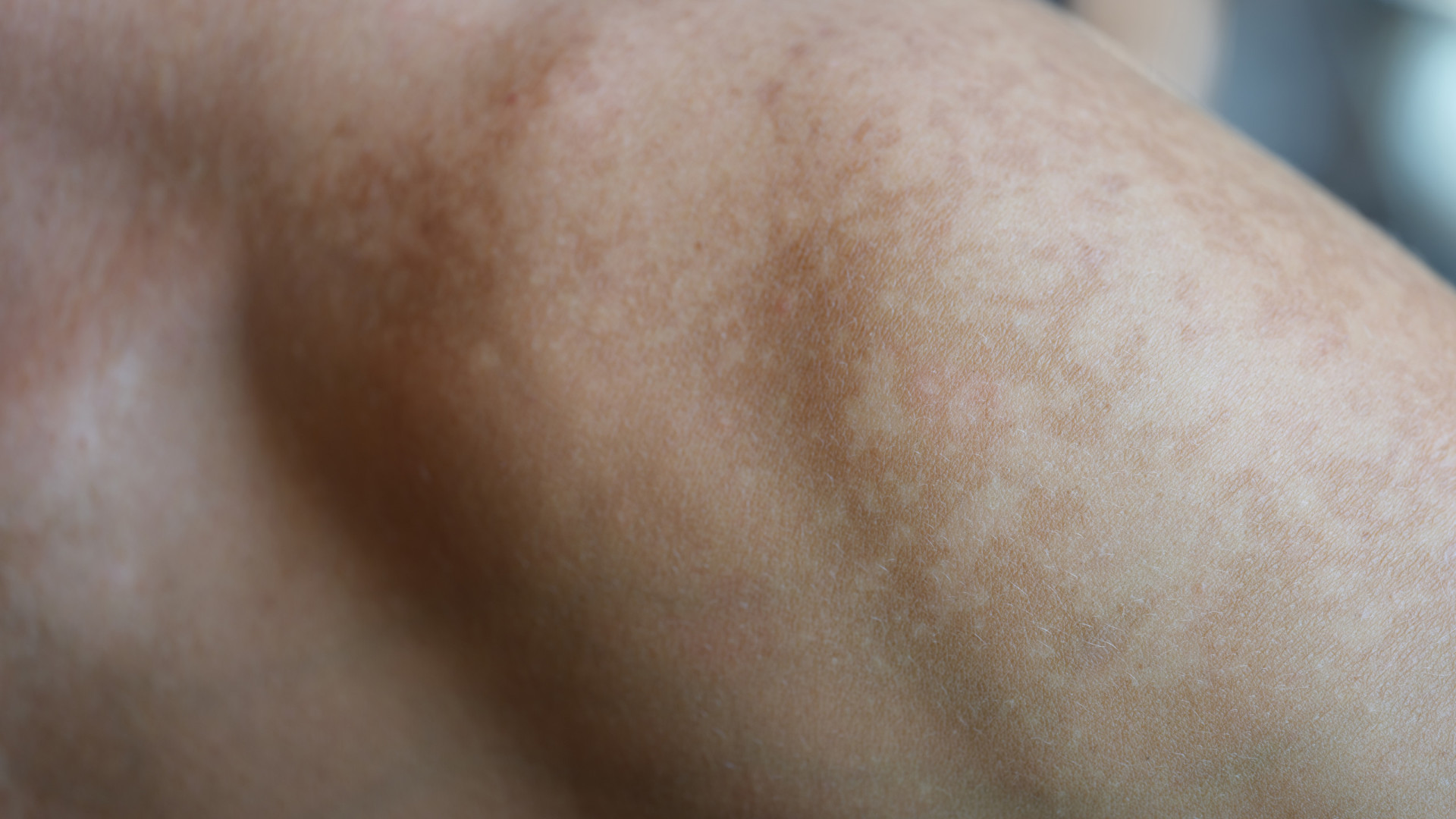 Everything you need to know about melasma