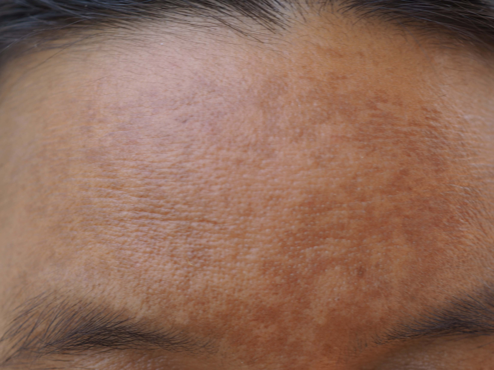 Everything you need to know about melasma