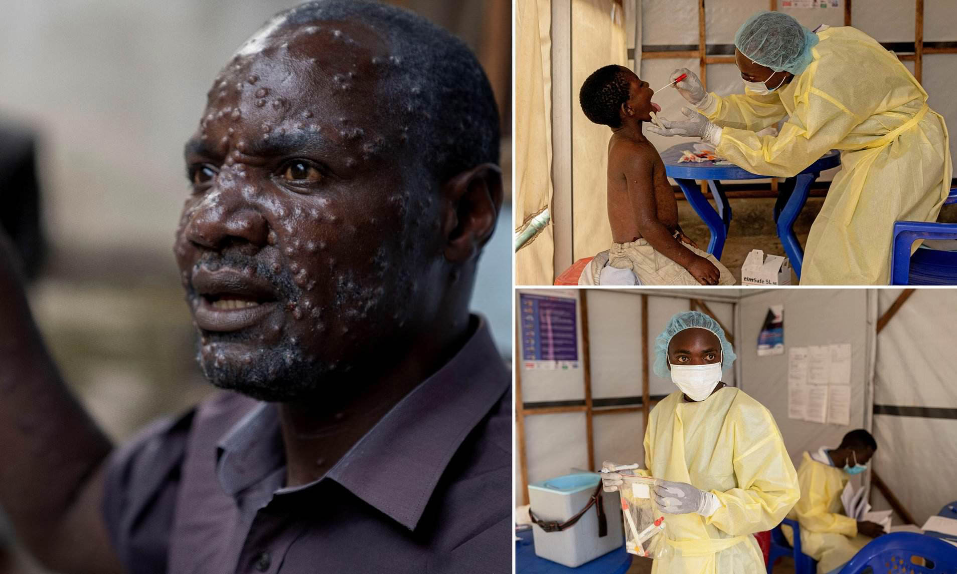 WHO declares Mpox outbreaks in Africa a global health emergency WHO declares Mpox outbreaks in Africa a global health emergency