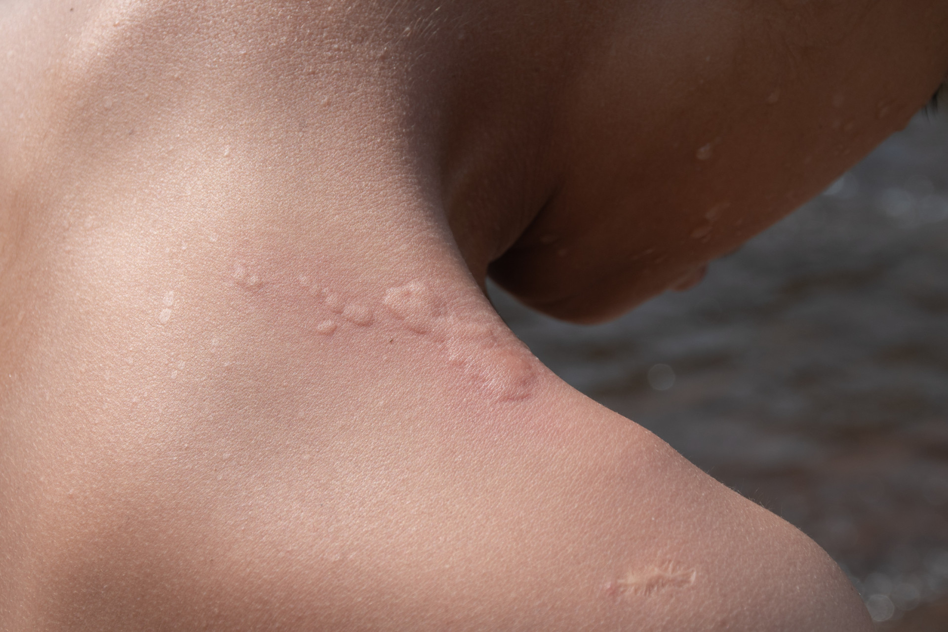 If you have these symptoms, you could be allergic to the sun