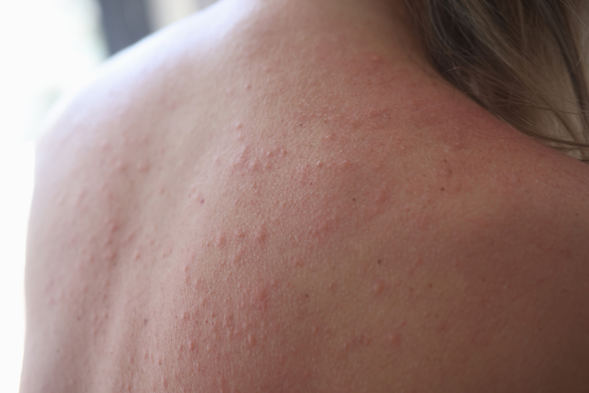 If you have these symptoms, you could be allergic to the sun