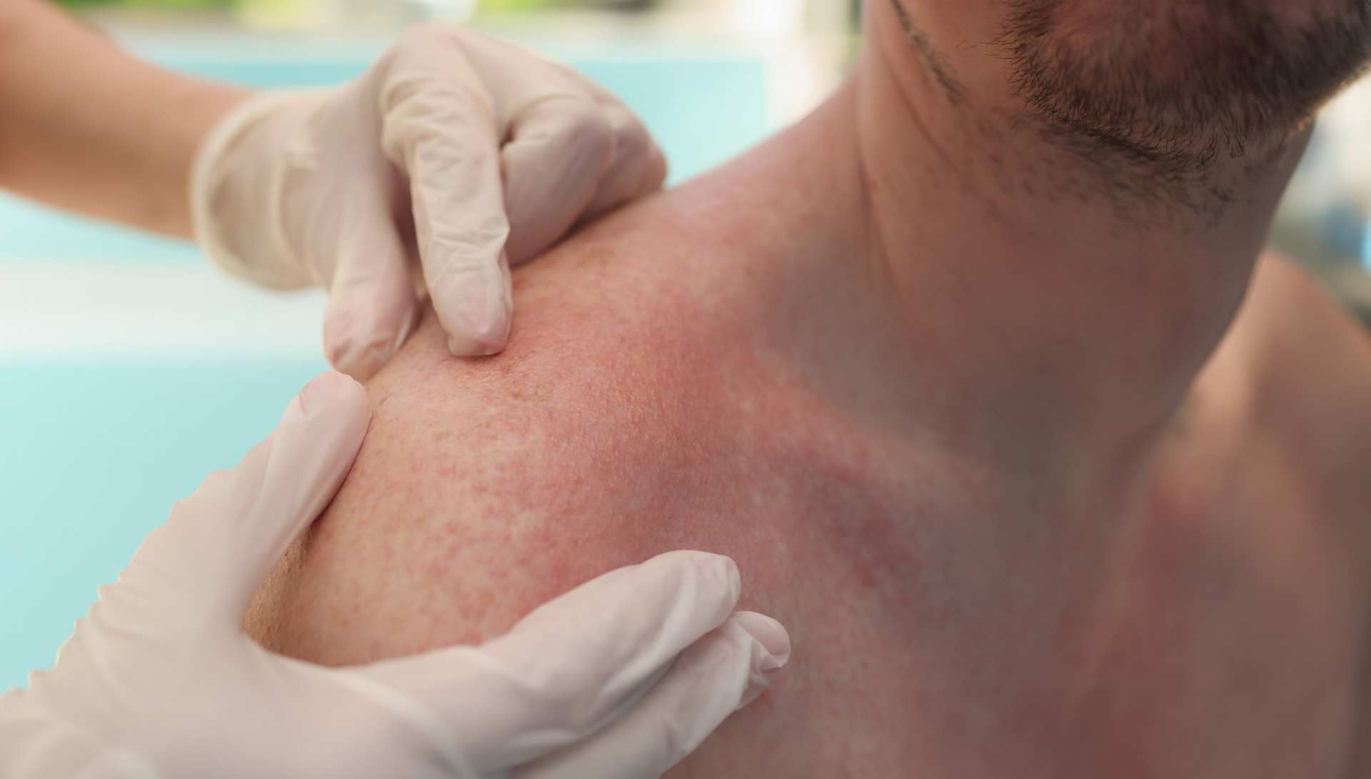 If you have these symptoms, you could be allergic to the sun