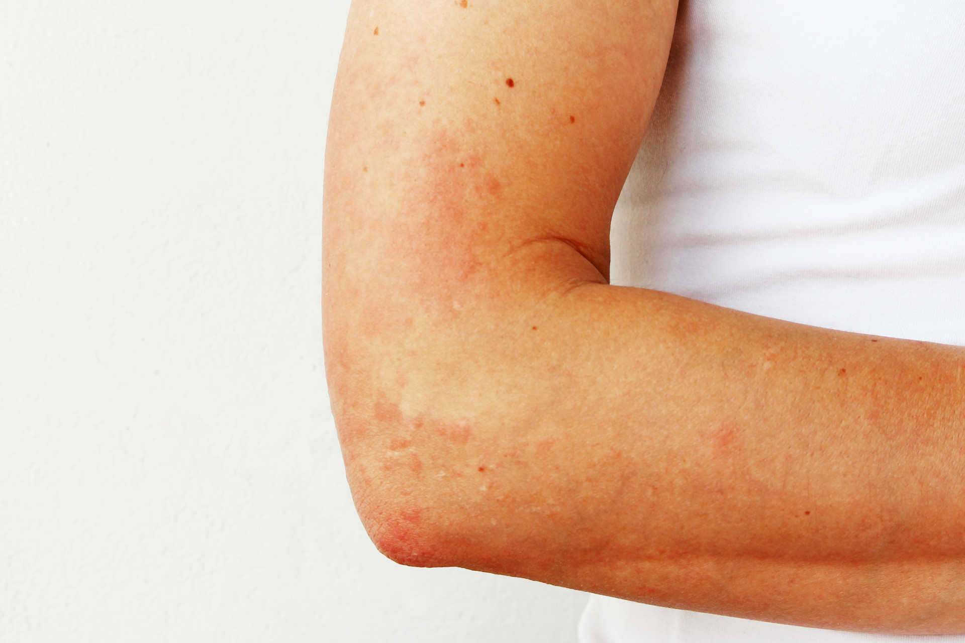 If you have these symptoms, you could be allergic to the sun